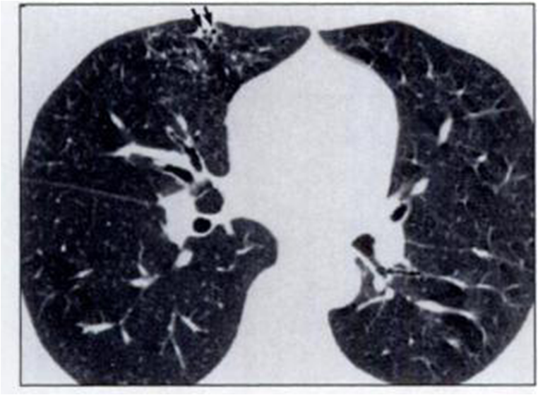 Chest Medicine Made Easy-Dr Deepu: The HRCT findings of Bronchiectasis.
