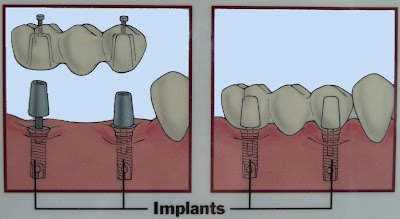 Implants