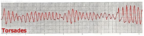 Med in Small Doses - Ventricular Tachyarrhythmias - IVLine