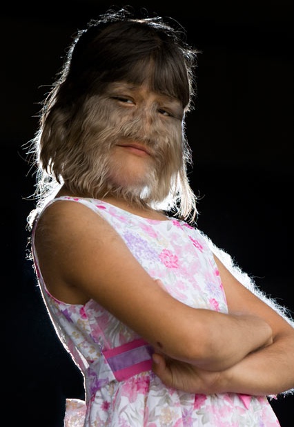 TYWKIWDBI ("Tai-Wiki-Widbee"): Hypertrichosis