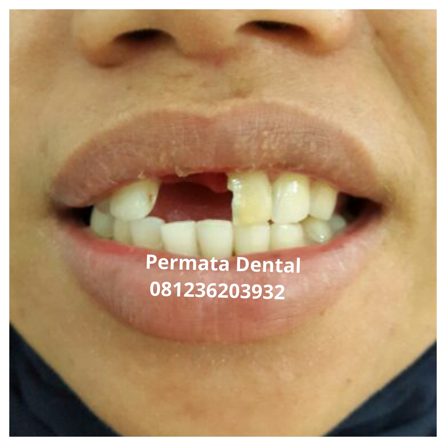 DOKTER GIGI BALI: Veneer Gigi | Samsung Gigi