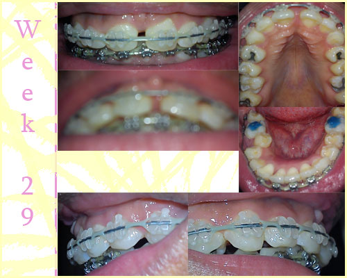 Metal Mouth Tales: Week 29: Small Hole in Molar Build Up