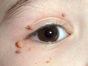 How To Remove Warts On Face - Moles, Warts & Skin Tags Removal