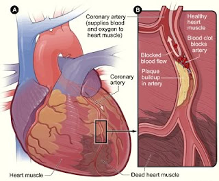 Pathophysiology of Heart Failure - Nursing Care Plan