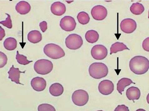Fichero: Anormalidades Morfológicas Eritrocitarias