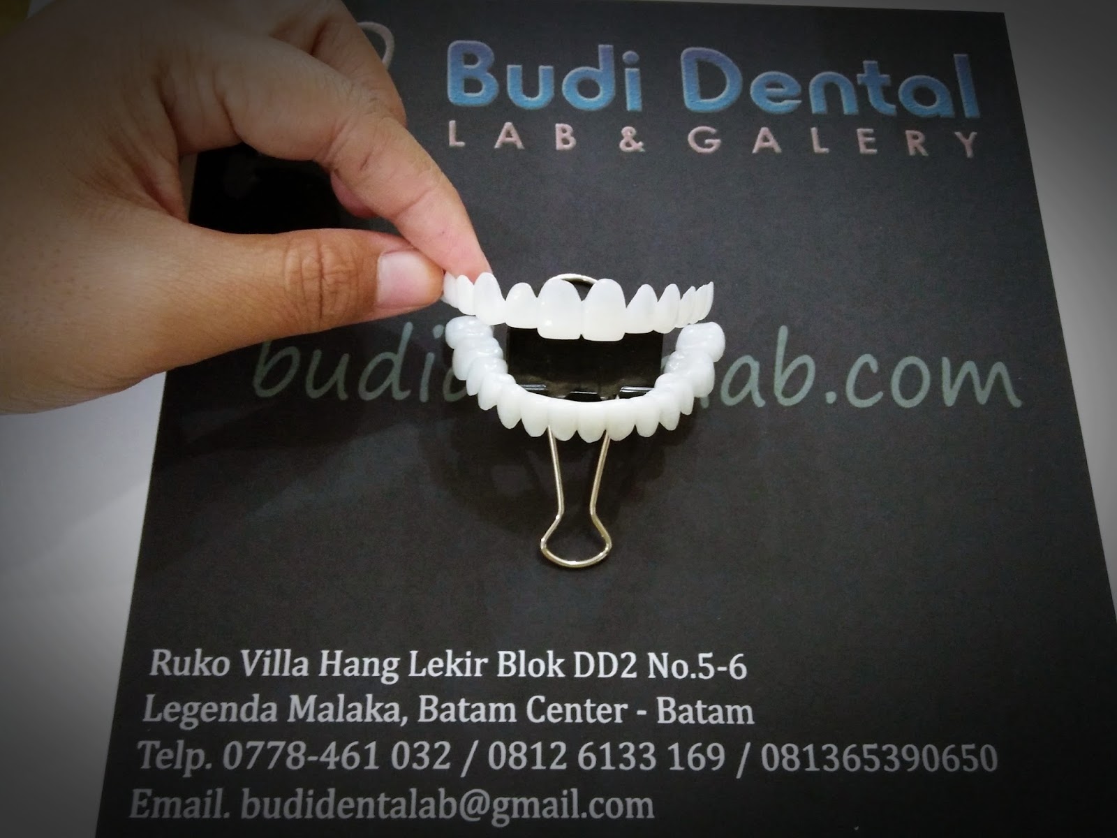 Removable Veneer / Snap On Teeth - Budi Dental