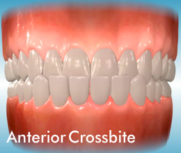 Surrideo Orthodontics - Damon Braces - Invisalign - Incognito: Glossary ...
