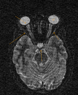 Idiopathic intracranial hypertension-MRI - Sumer's Radiology Blog
