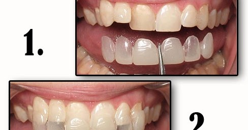 Periodontia e Implantes: “Mock-ups” em Odontologia Estética