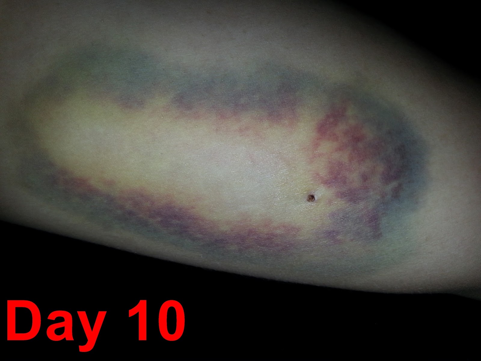 My experience with the birth control Implanon