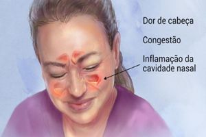 O que é sinusites? Sintomas, causas e tratamento
