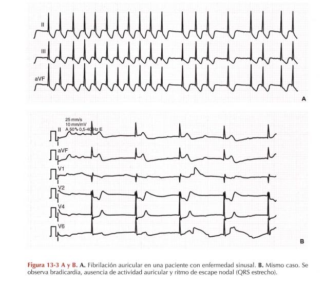 LIBROS DE MEDICINA: Fibrilación auricular