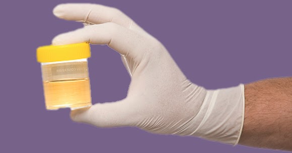 COLLECTING A TWENTY-FOUR HOUR URINE SPECIMEN ~ Nurses Guide