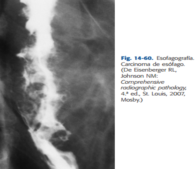 Estudios Contrastados del Sistema Digestivo: Esofagografía