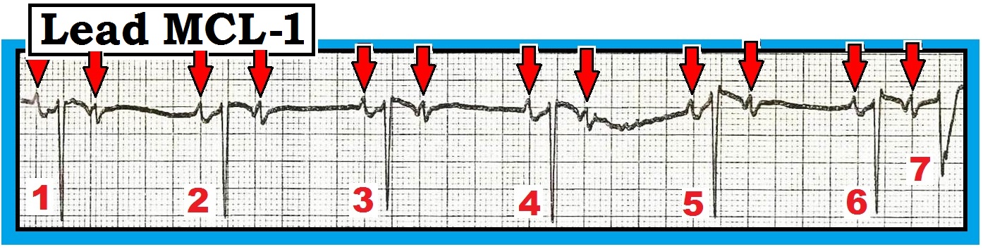 ECG Interpretation: ECG Interpretation Review #57 (Mobitz I - Mobitz II ...
