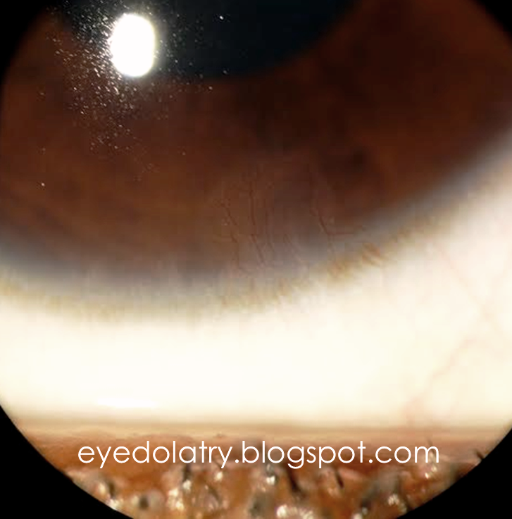 Pannus Human Eye