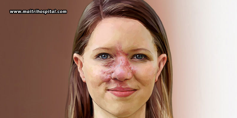 AVM – What It Is, Its Types, Its Symptoms, And Its Treatments