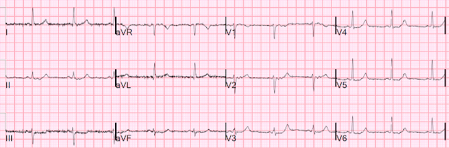 Dr. Smith's ECG Blog: Chest pain and Diffuse ST depression, with STE in ...