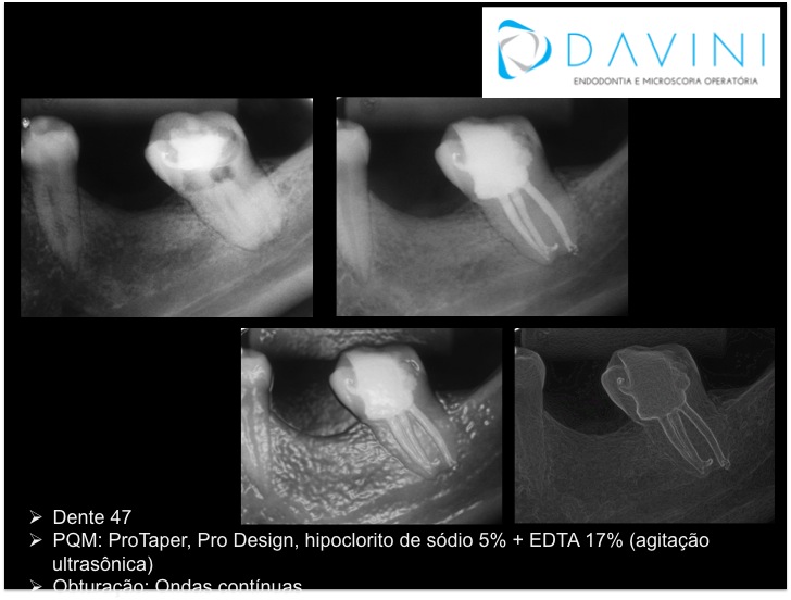 Davini - Endodontia e Microscopia Operatória: Dente 47 - anatomia ...
