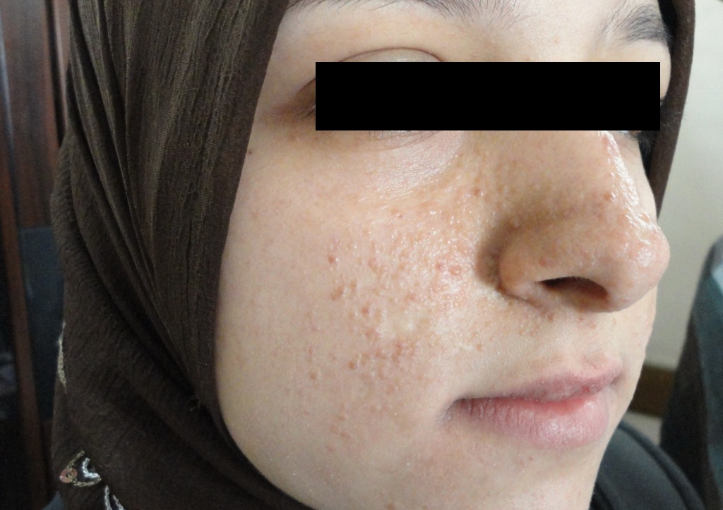 Skin Tumors: Adenoma sebaceum