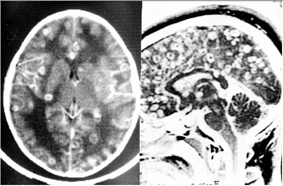 Cysticercosis - Hannah Vaught Histology Blog: Diagnosis, Treatments ...