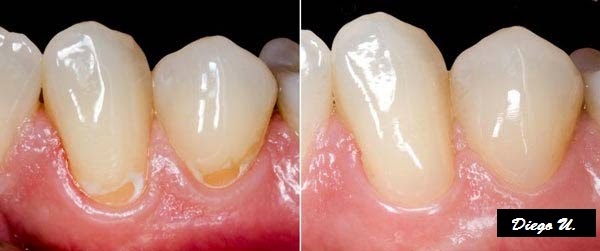 Sonrisas del mundo: La Abfracción