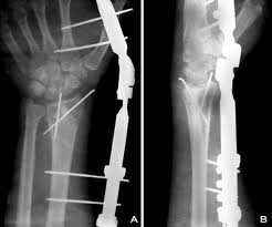 la enfrermeria quirurjuca: Osteosíntesis
