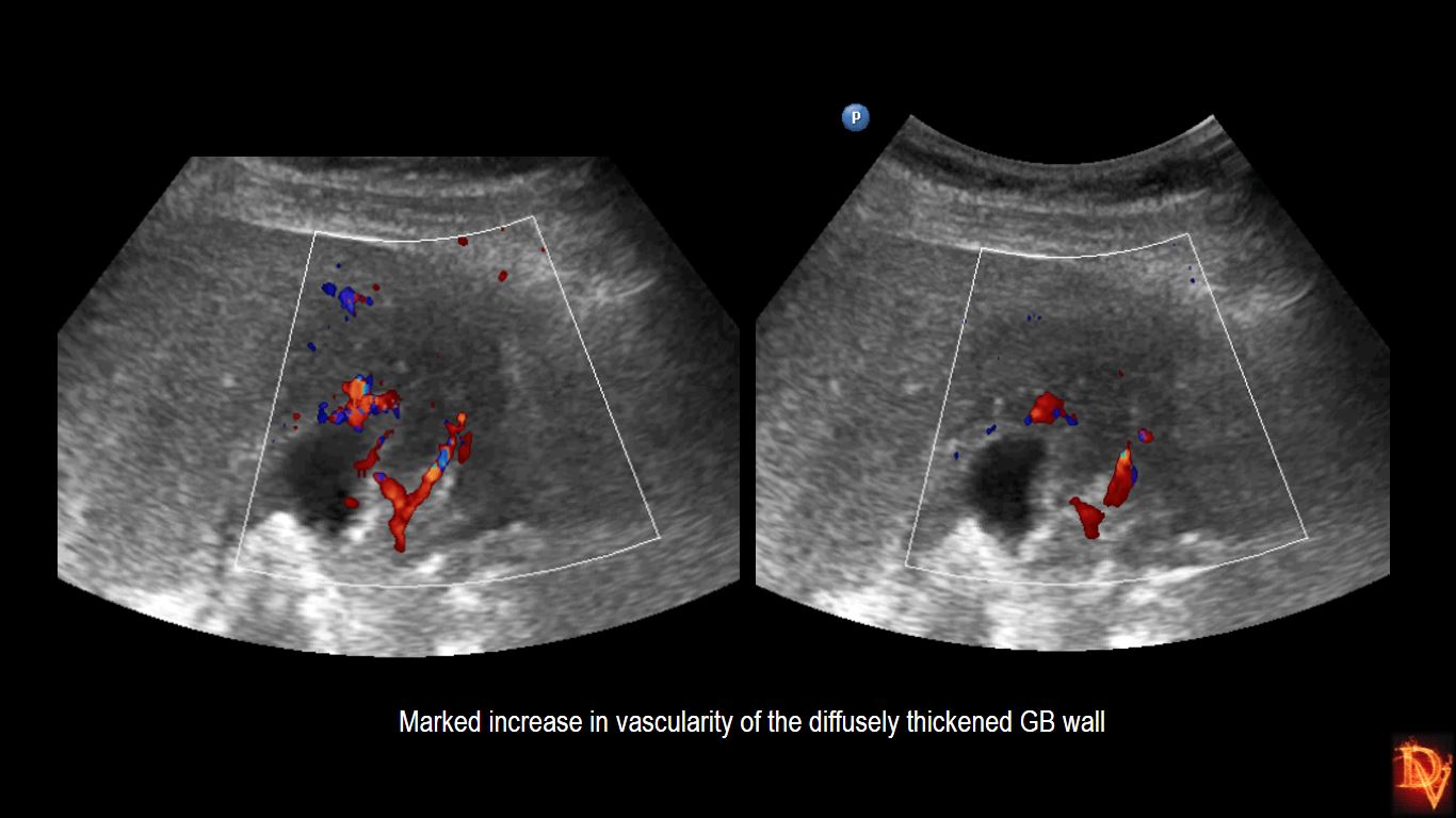 Ultimate Radiology : Xanthogranulomatous Cholecystitis (Histology from ...