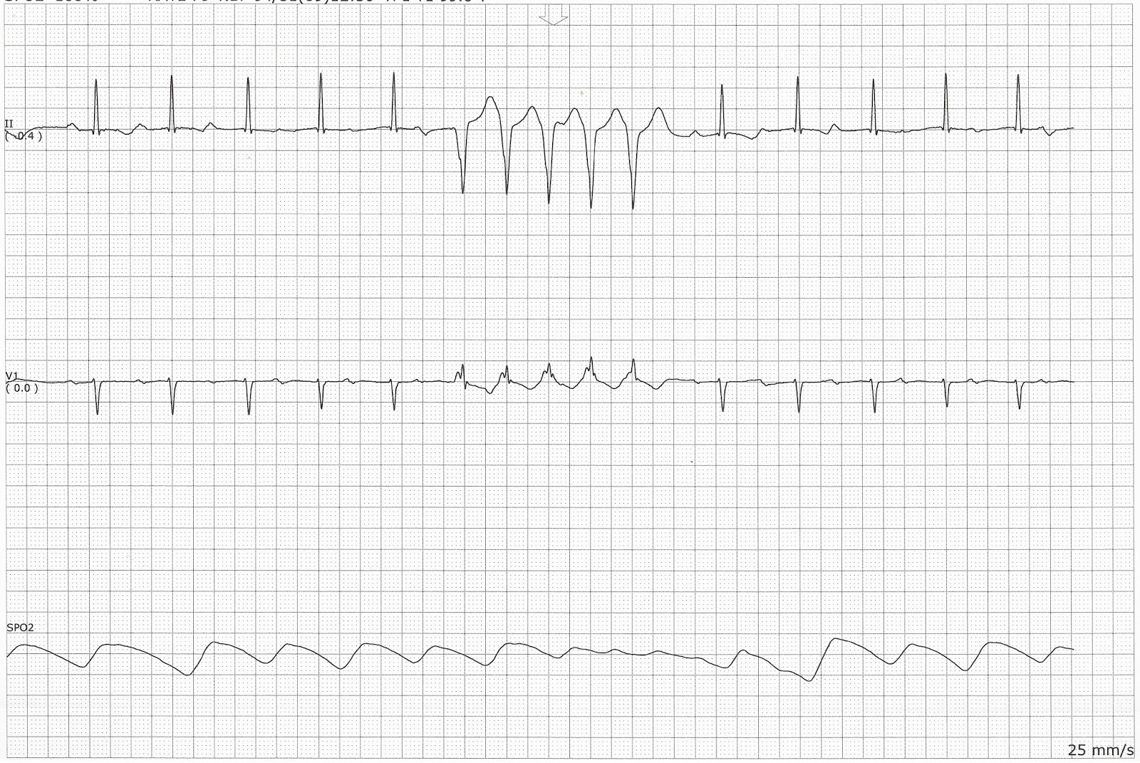 Practice EKG Strip