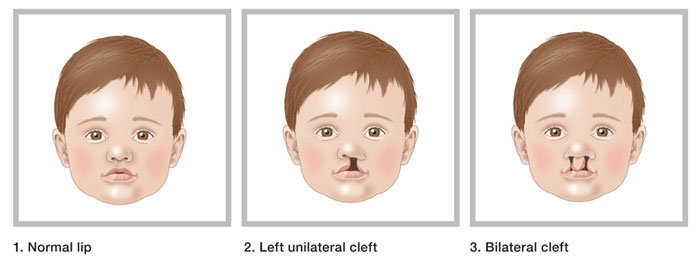Pediatric Dentist, Bangalore: Cleft Lip - Handling This Congenital ...