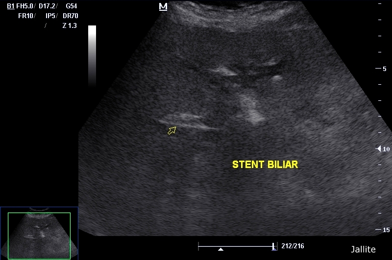 Stent Biliar