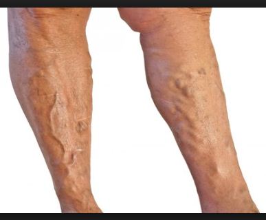 Makalah Biologi tentang "VARISES" | Pustaka Ilmu