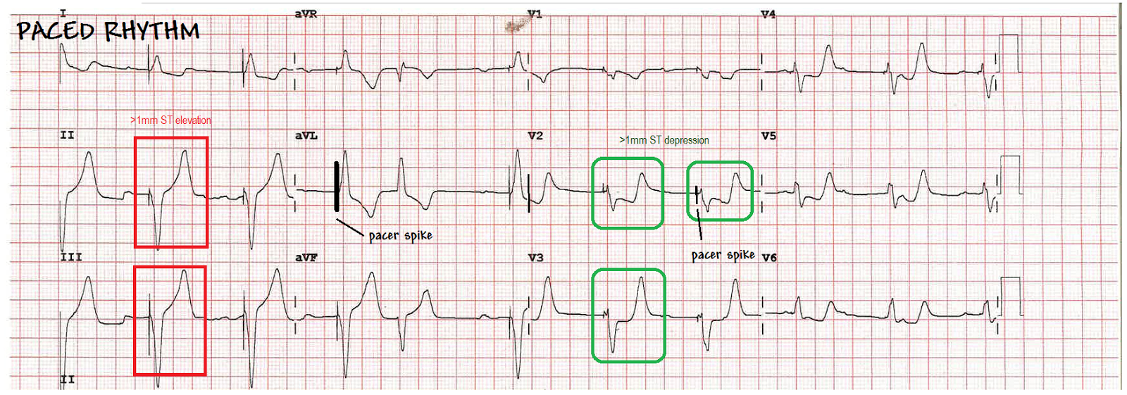 Paramedic Student Central: Sgarbossa’s Criteria