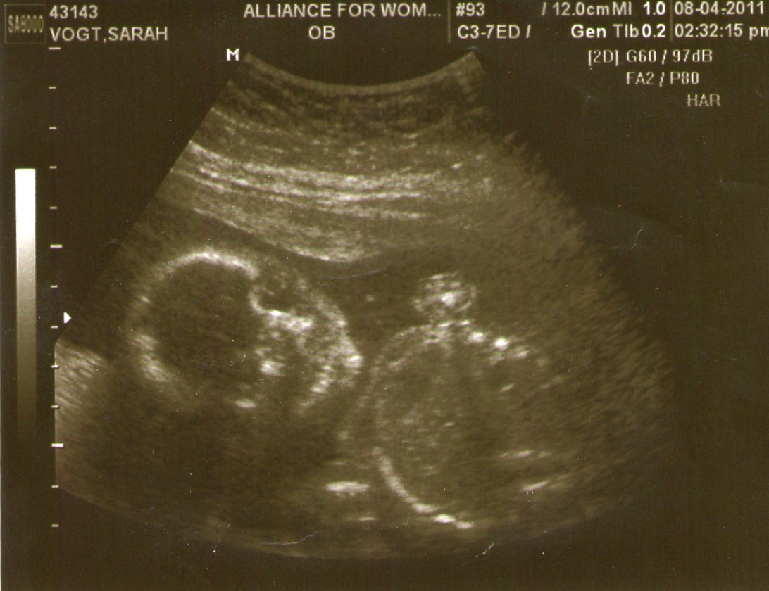 Our little bundle of Joy: 21 weeks 5 days