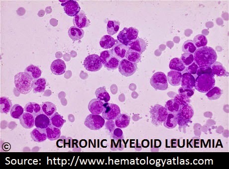 Lab Atlas: Chronic Myeloid Leukemia