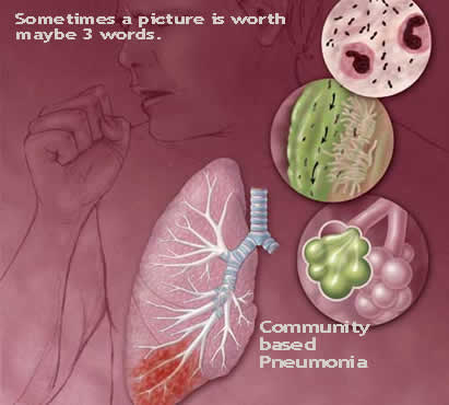 Health Care: Pneumonia