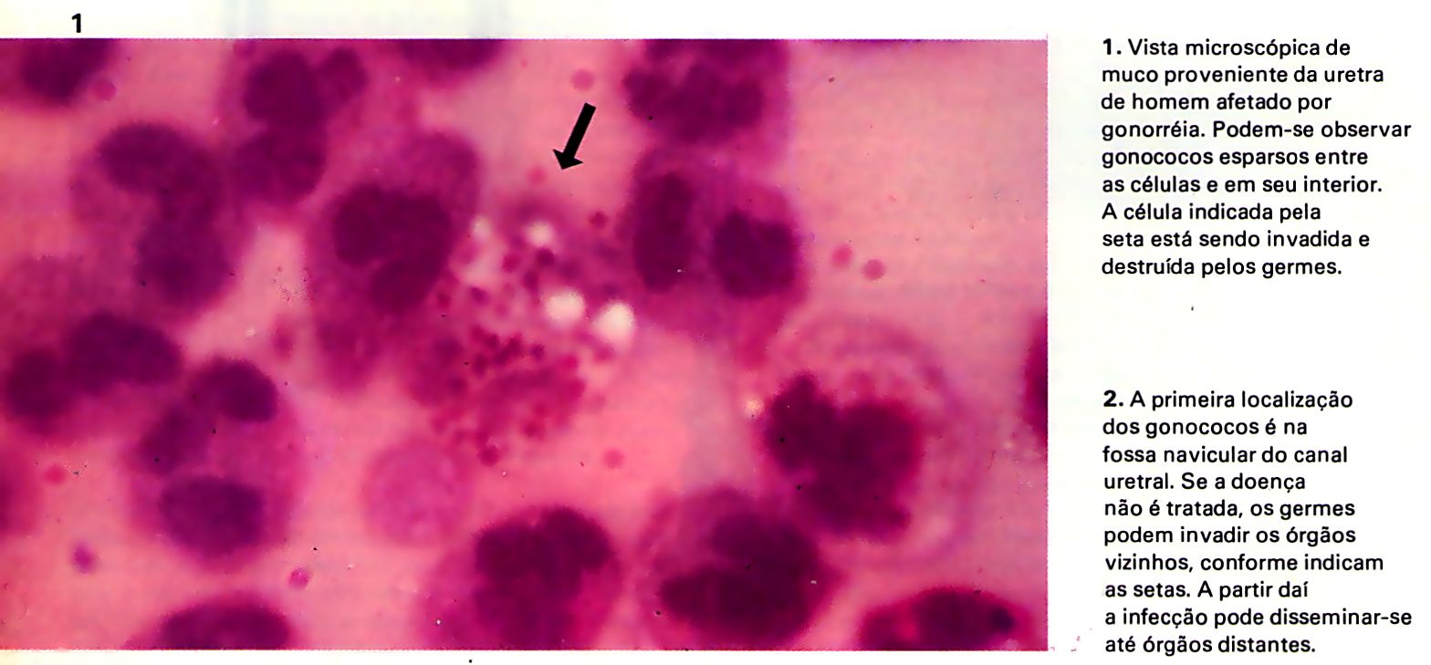 ARTRITE - OSTEOARTRITE - ARTROSE - REUMATISMO E TRAUMAUTISMO: 5) A ...