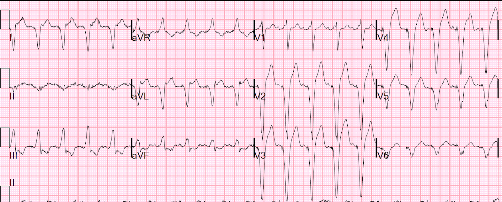 Dr. Smith's ECG Blog: Paced rhythm. Is there Ischemic ST elevation?