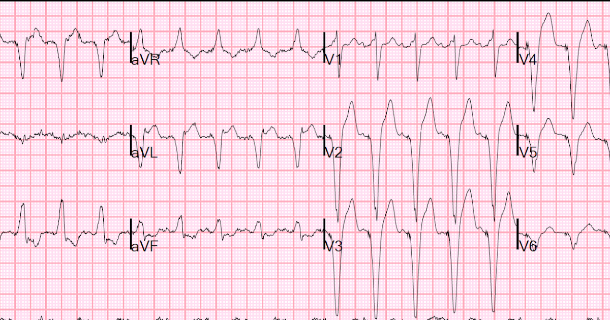 Dr. Smith's ECG Blog: Paced rhythm. Is there Ischemic ST elevation?