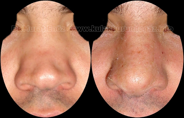 Risk Factors For Intraoperative Saddle Nose Deformity In Septoplasty ...