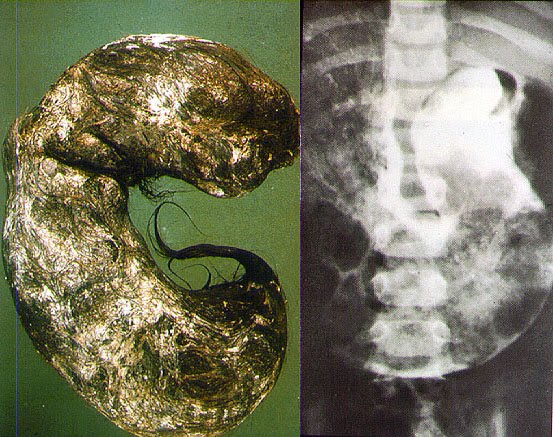 Cético ou crente: Bezoar