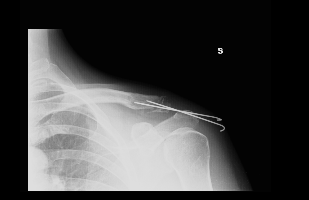 Bramley's garage: Clavicola - Collar bone.