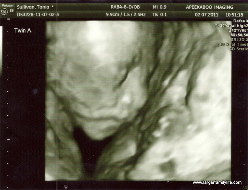 4d baby scans, anomaly scans and the miracle of life | Larger Family Life