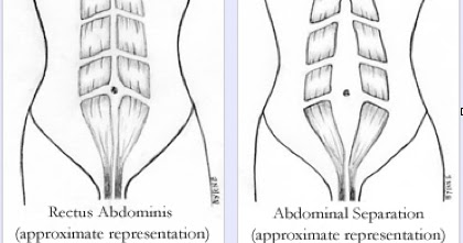 Abdom Updates: How do you fix Diastasis Recti?
