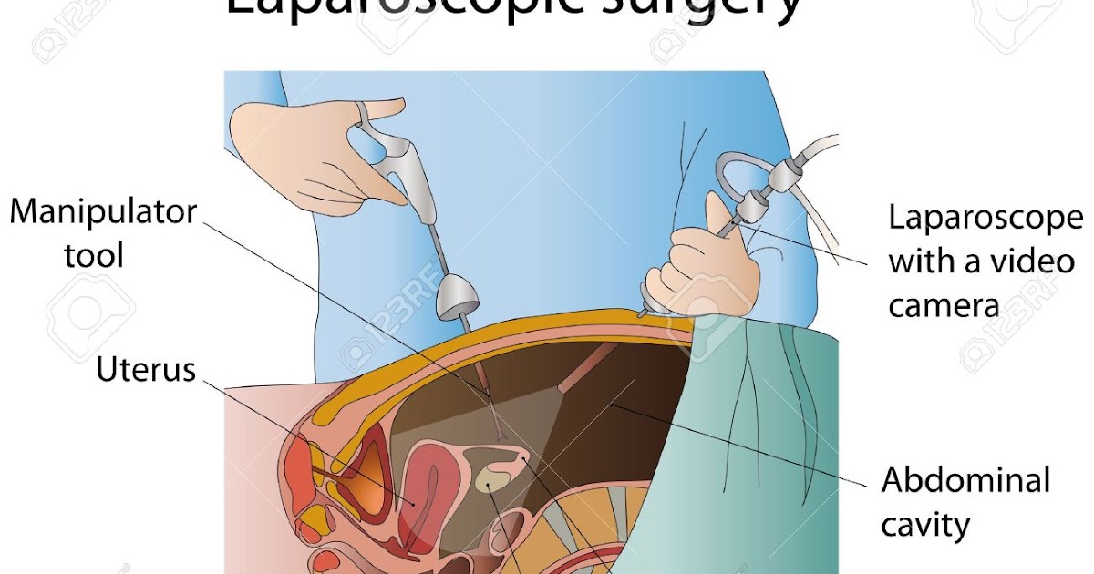 Laparoscopic Treatment : Purpose, Procedure & Recovery: Laparoscopic Myomectomy Surgery in India ...