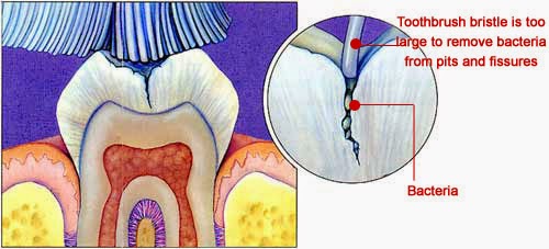 Kiira: Fissures in Teeth/ Gum recession