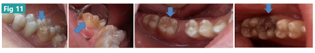 Molar Incisor Hypomineralization (MIH): Conservative Treatment Approach