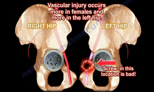 Dr. Nabil Ebraheim's Blogspot: Total Hip Acetabular Screw Placement