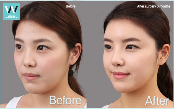 Short nose correction plastic surgery in Korea
