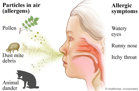 Mommy's Diary of Life: ALLERGIC RHINITIS – ALAHAN BERKAITAN SISTEM ...